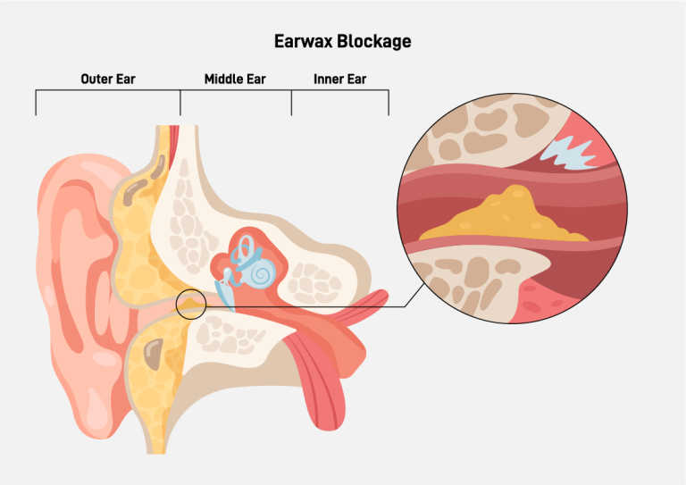 Ear Wax Removal | Ear & Hearing Clinic
